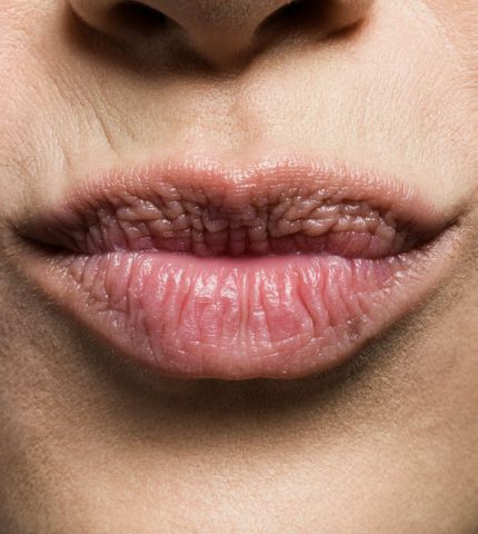 Come curare le afte con la natura - Donna Moderna