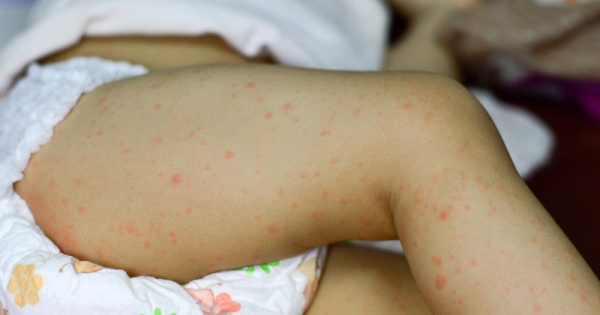 Morbillo: sintomi, vaccino e cura - Donna Moderna