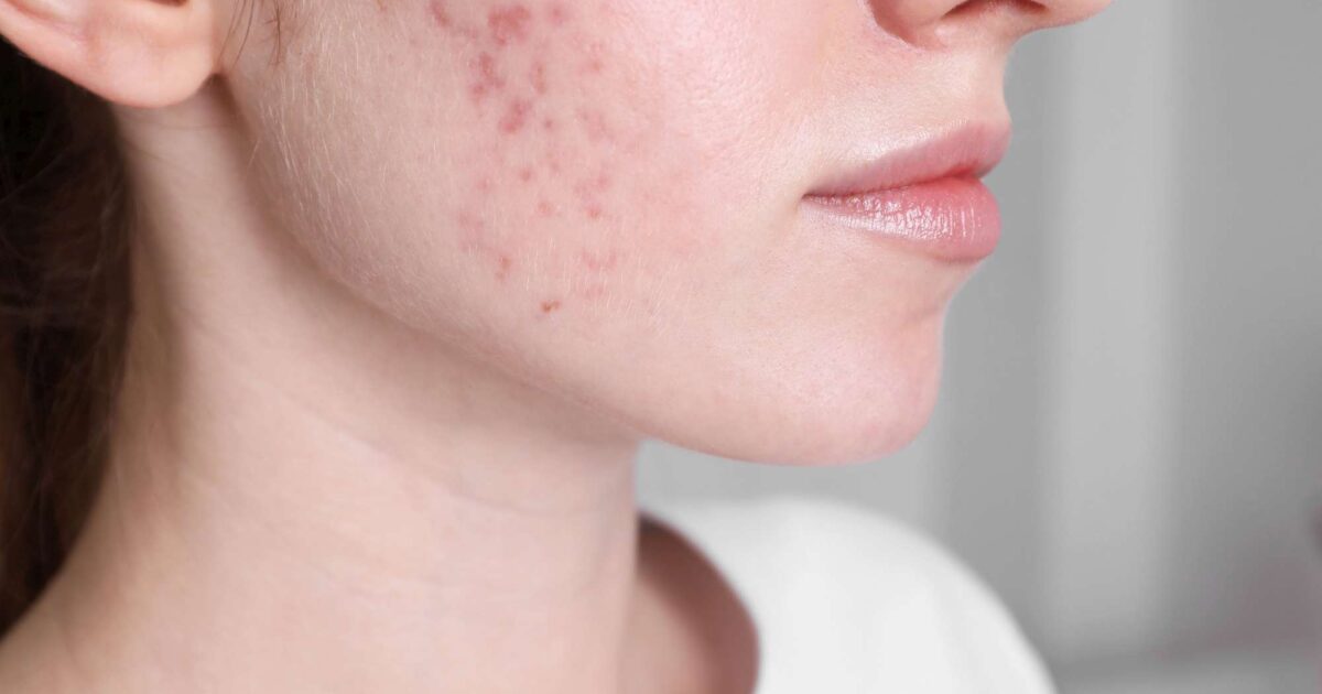 Acne estiva, cause e rimedi - Donna Moderna